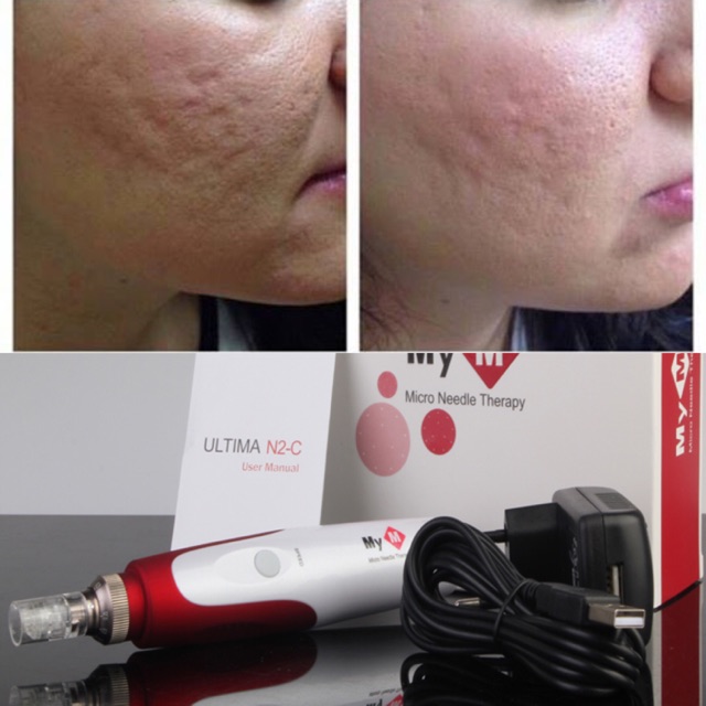Microneedling Price & Promotion-Oct 2022|BigGo Malaysia